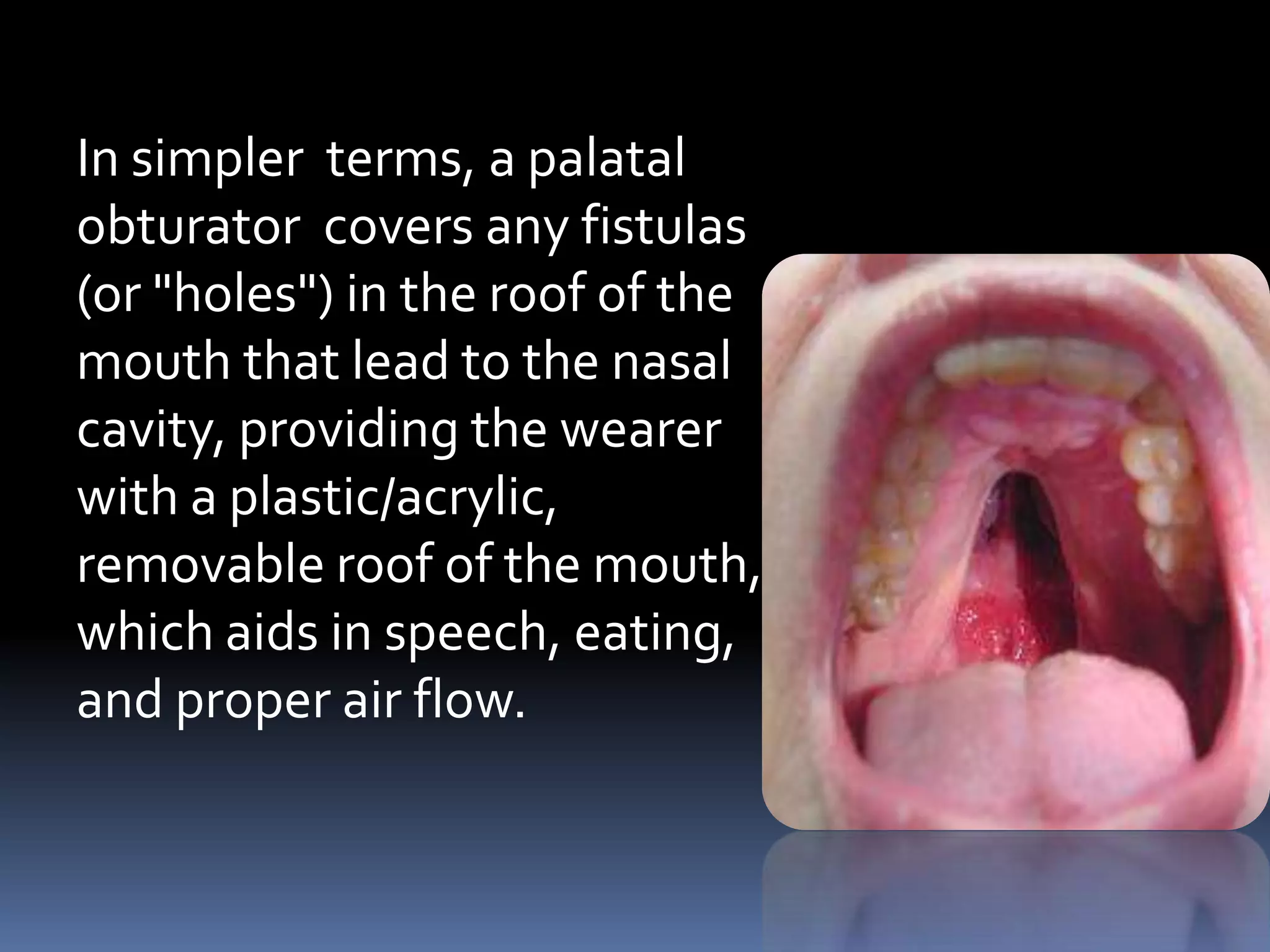 Maxillofacial prosthesis of soft cleft palate | PPTX
