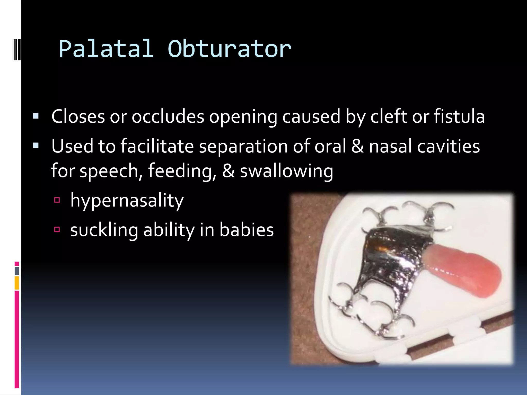 Maxillofacial prosthesis of soft cleft palate | PPTX