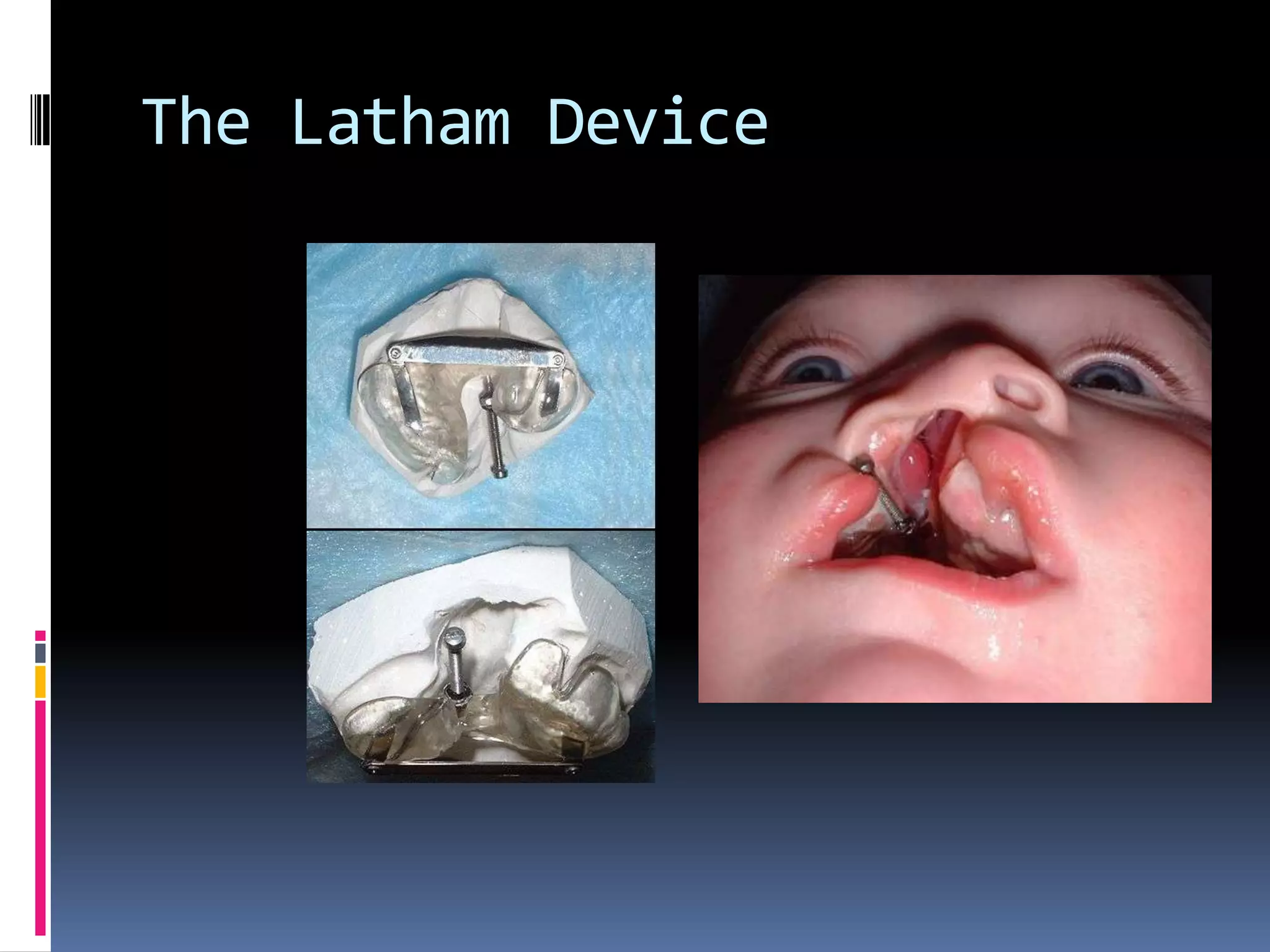 Maxillofacial prosthesis of soft cleft palate | PPTX