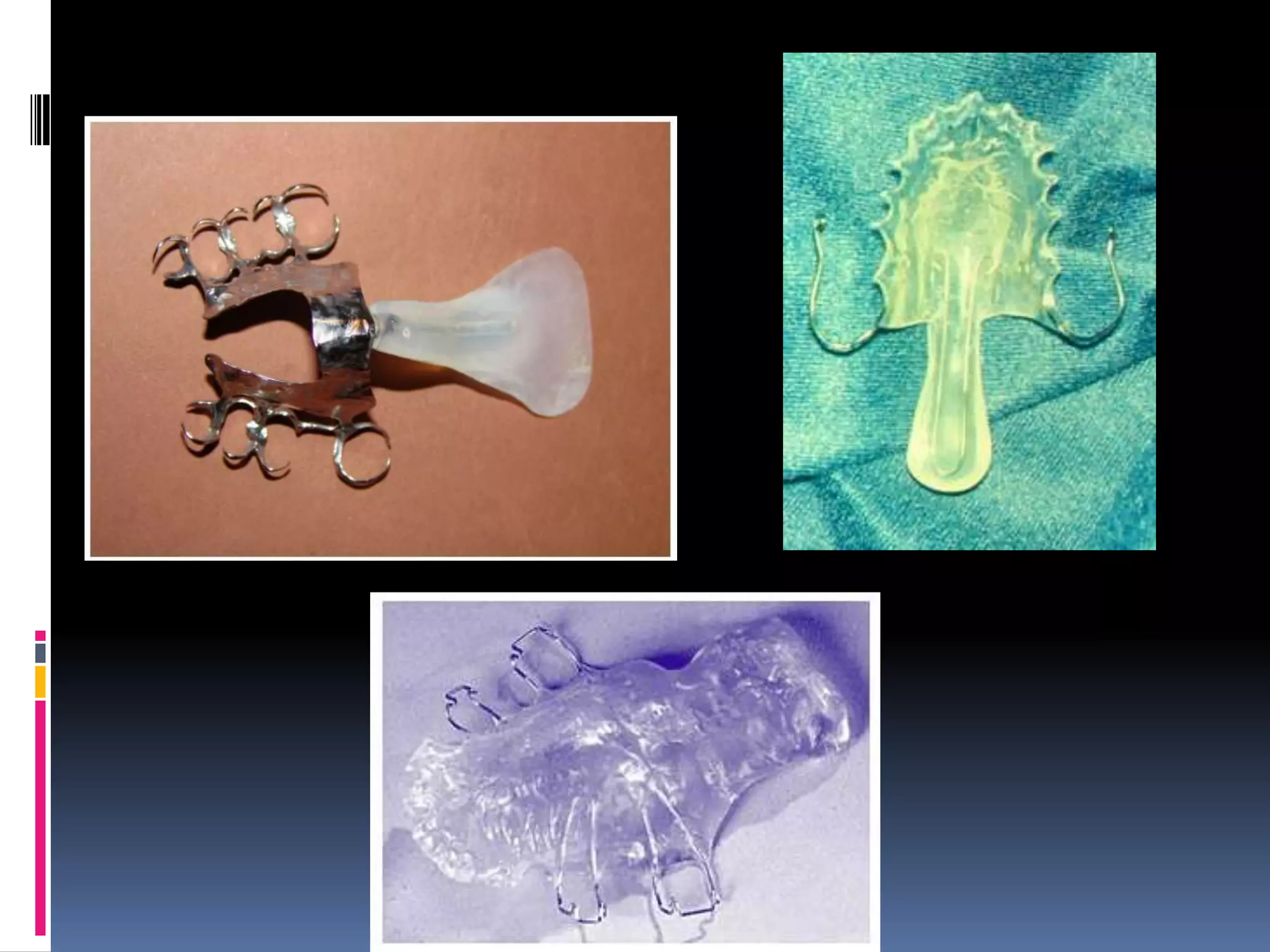 Maxillofacial prosthesis of soft cleft palate | PPTX