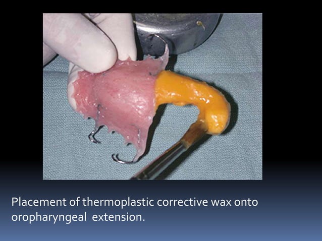 Maxillofacial prosthesis of soft cleft palate | PPTX