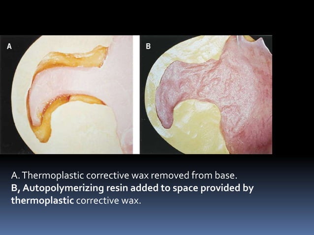 Maxillofacial prosthesis of soft cleft palate | PPTX