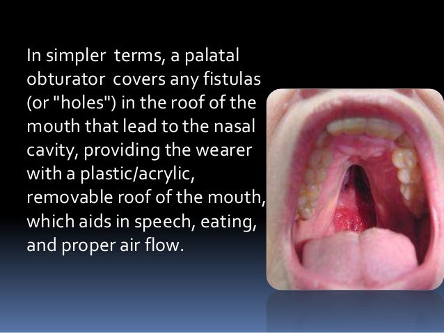 Maxillofacial prosthesis of soft cleft palate