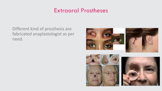 Maxillofacial Prosthetics | Intro & Basics, Obturator, Splint, Intra ...