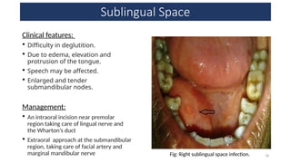 Maxillofacial space infection and management.pptx