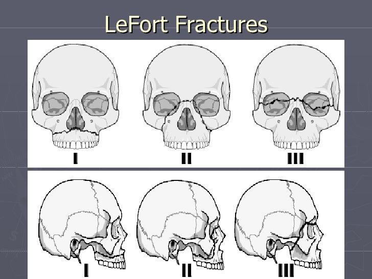 Lefort Fracture Repair