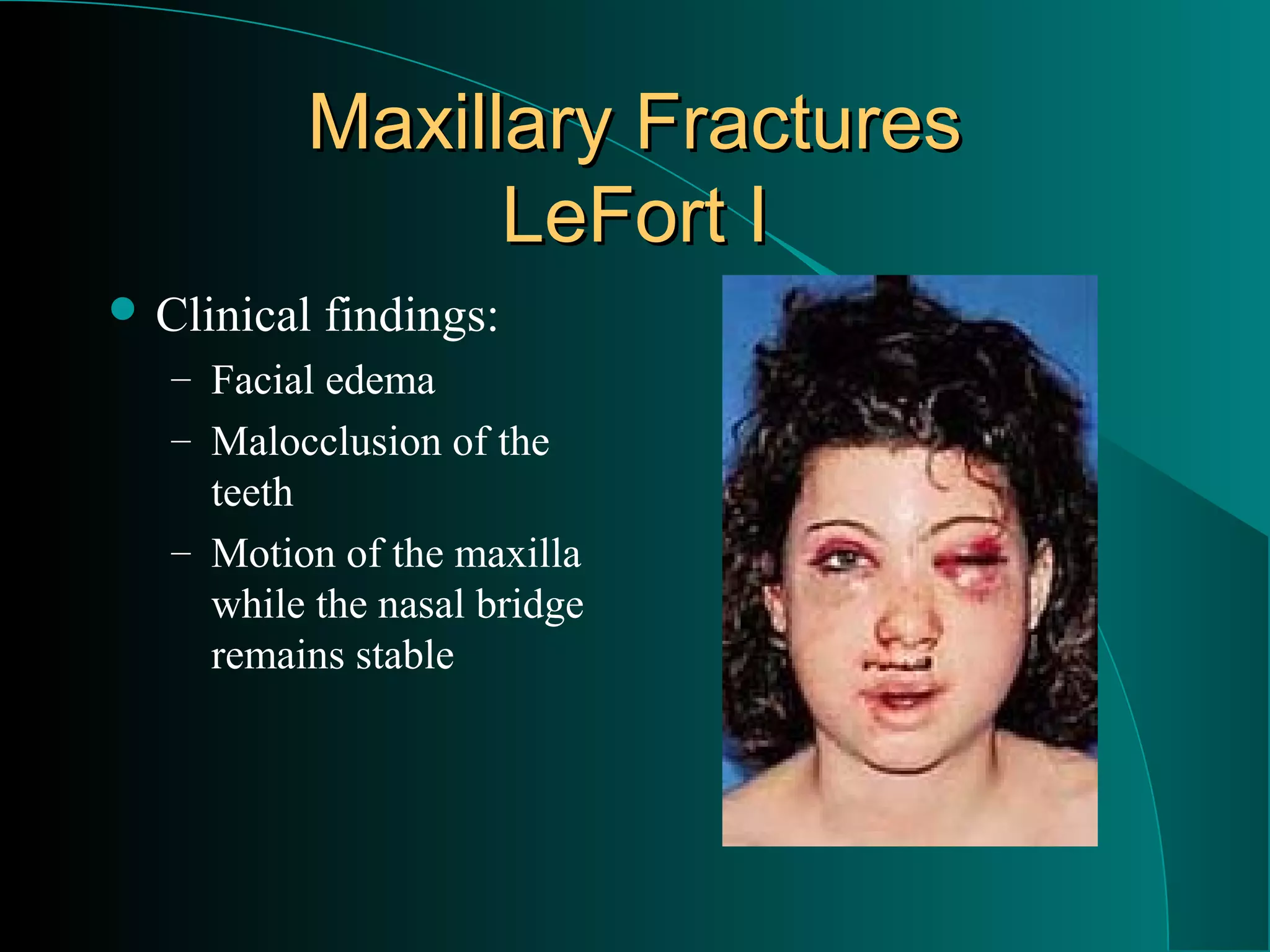 Maxillofacial trauma | PPT