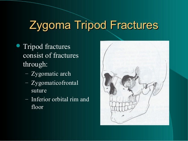 Tripod Fracture Diagram