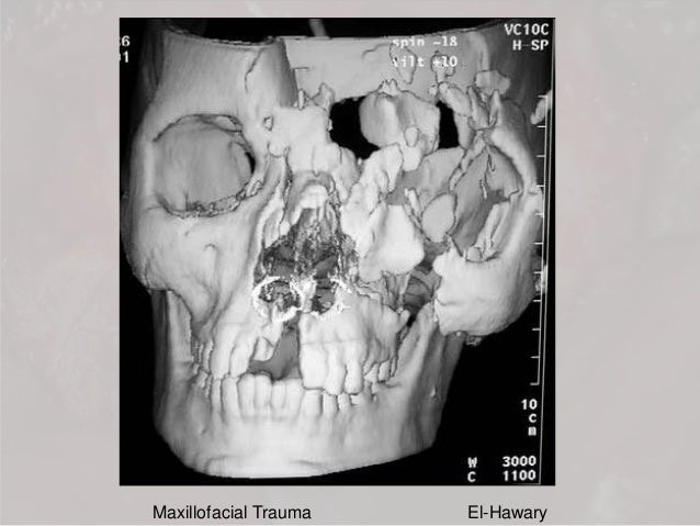 Maxillofacial Trauma