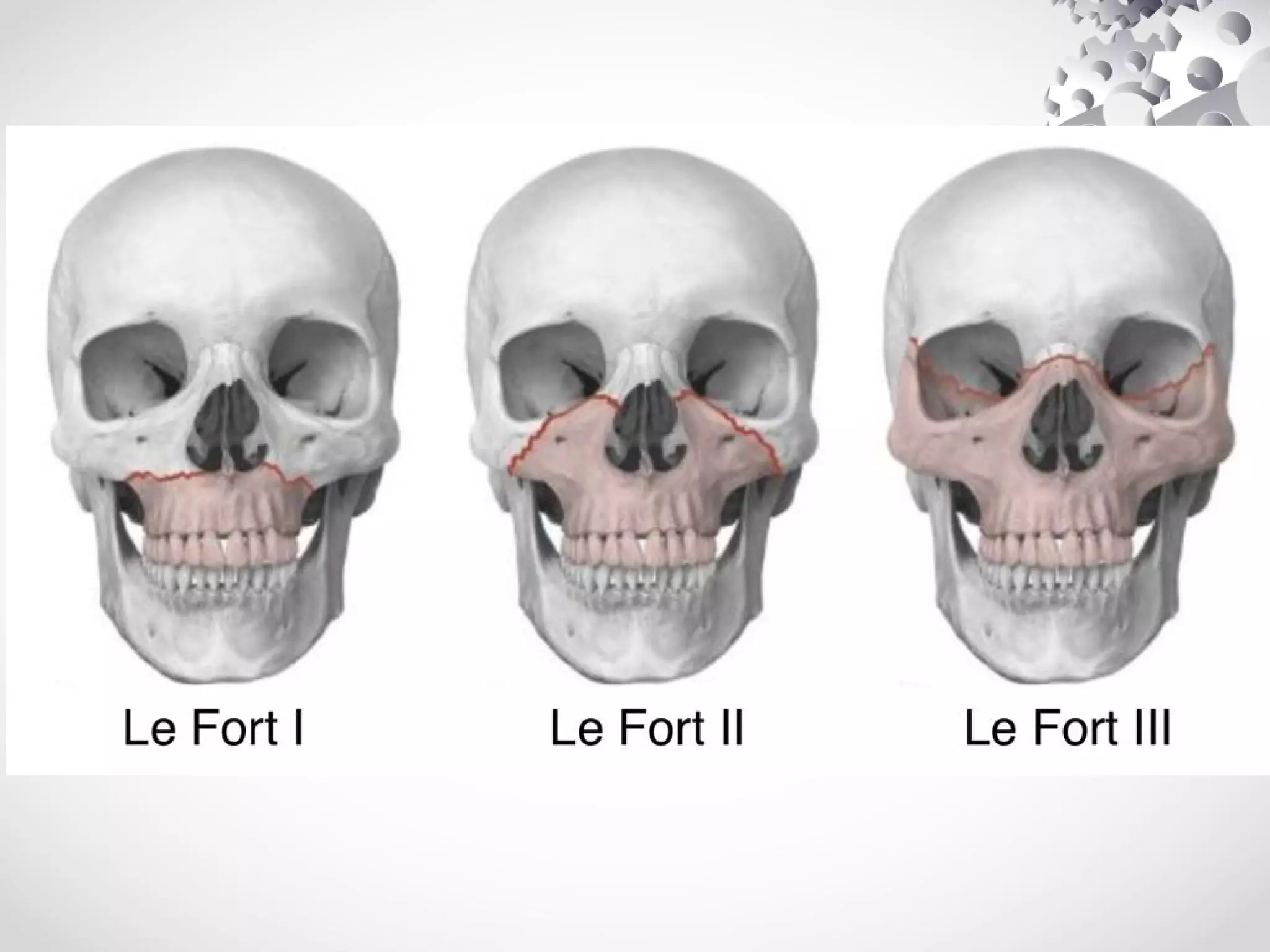 Maxillo facial trauma | PPT