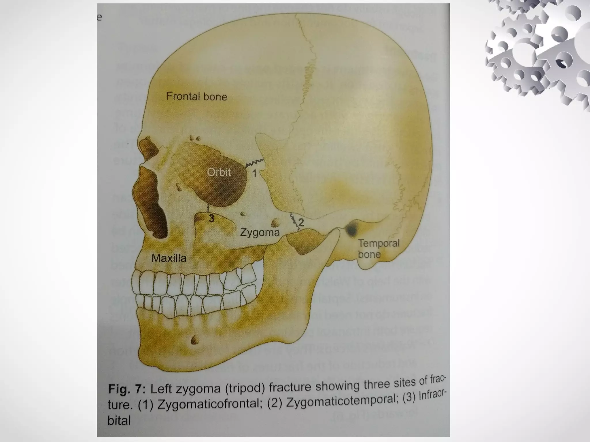 Maxillo facial trauma | PPT