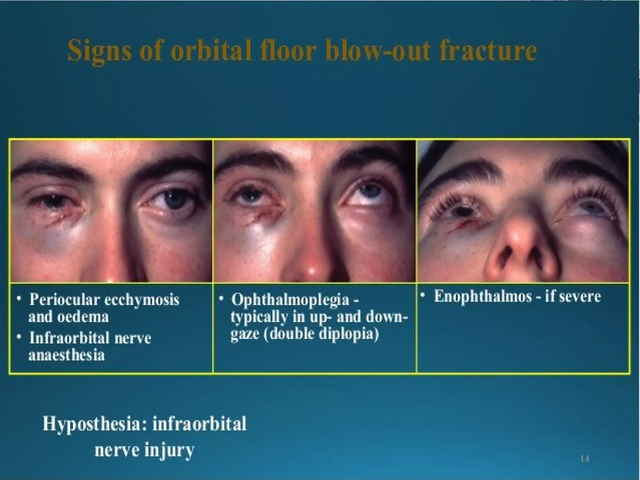 Maxillo facial trauma | PPT