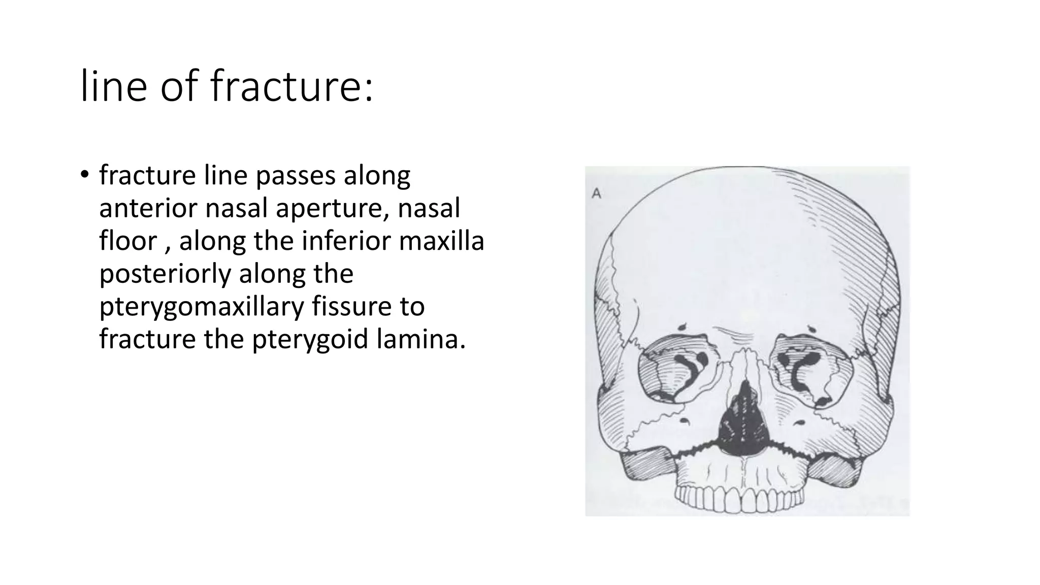 Maxillo facial trauma | PPT