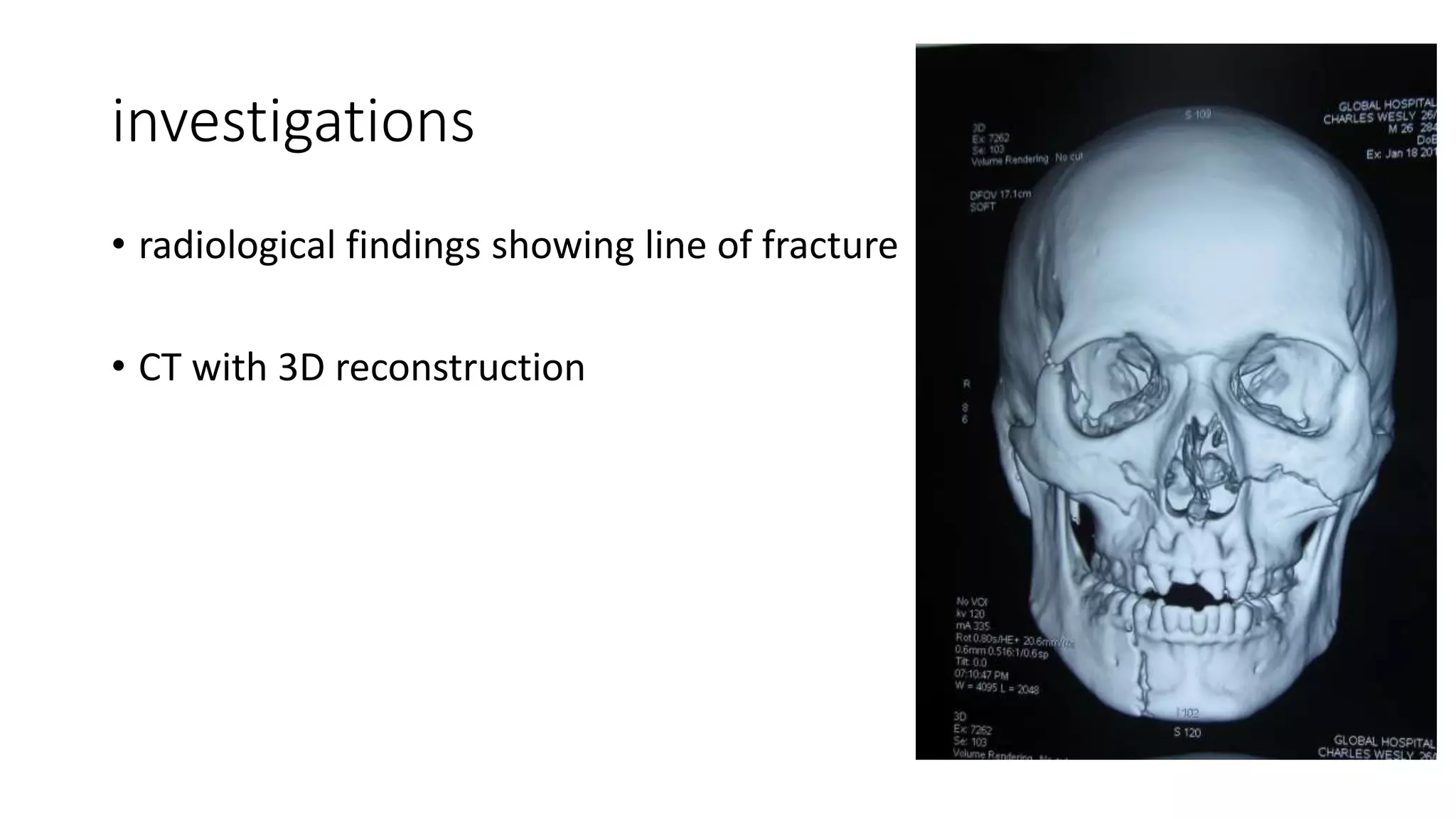 Maxillo facial trauma | PPT