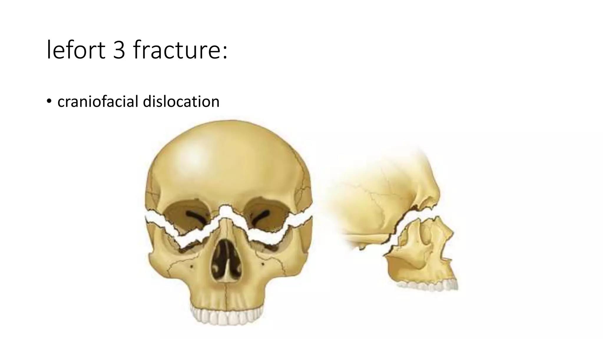 Maxillo facial trauma | PPT