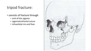 Maxillo facial trauma | PPT