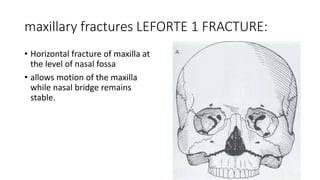 Maxillo facial trauma | PPT