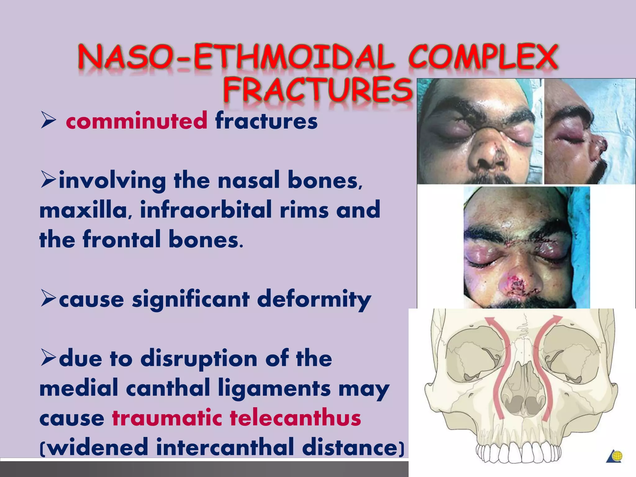 MAXILLO FACIAL TRAUMA (Bailey and Love) | PPTX