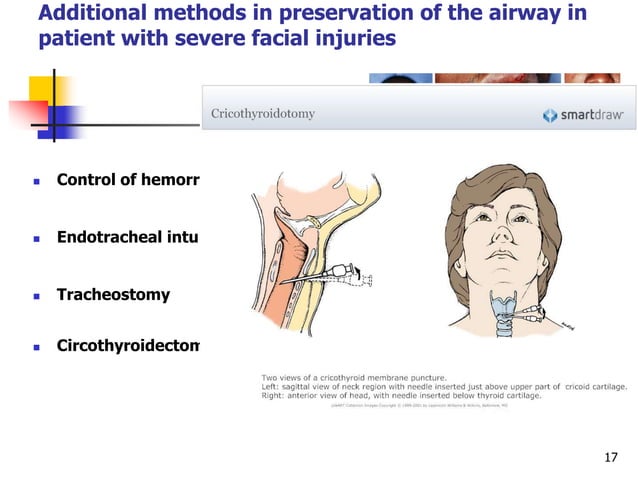 Maxillofacial Trauma emergency management.ppt