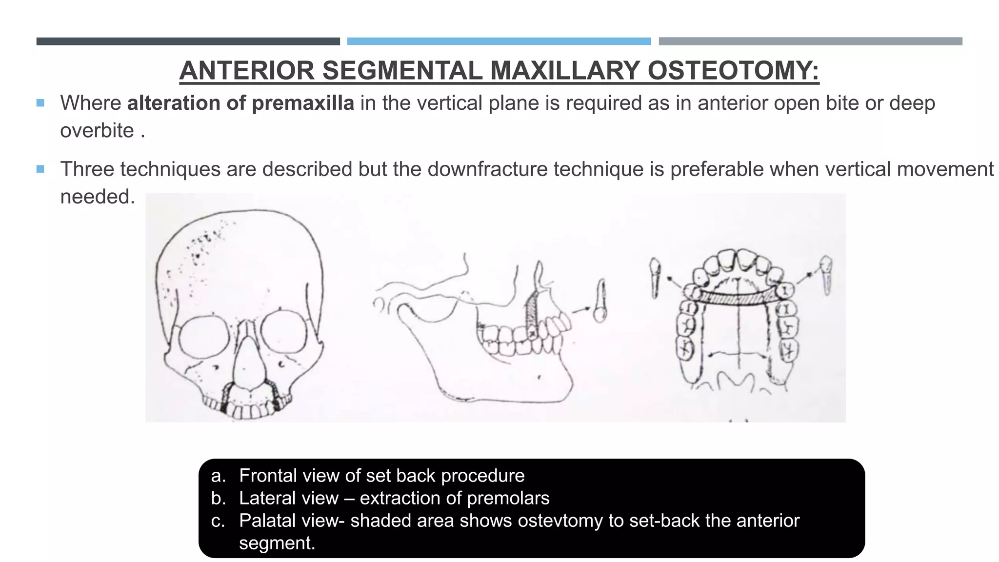 MAXILLRY OSTEOTOMY.pptx