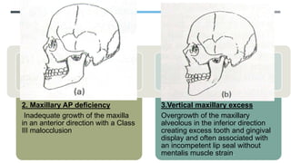 MAXILLRY OSTEOTOMY.pptx