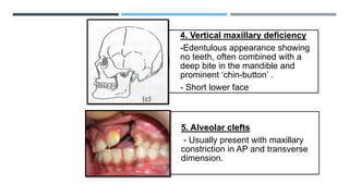 MAXILLRY OSTEOTOMY.pptx