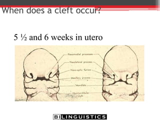Maximizing Treatment Effects with VPI and Cleft Lip and Palate | PDF
