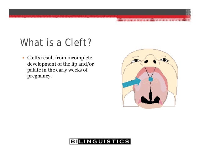 Maximizing Treatment Effects with VPI and Cleft Lip and Palate