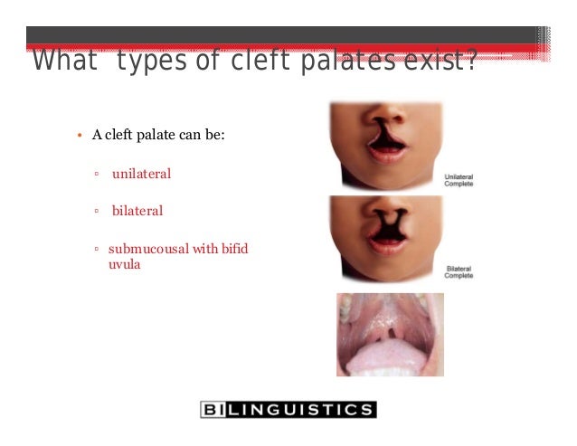 Maximizing Treatment Effects with VPI and Cleft Lip and Palate