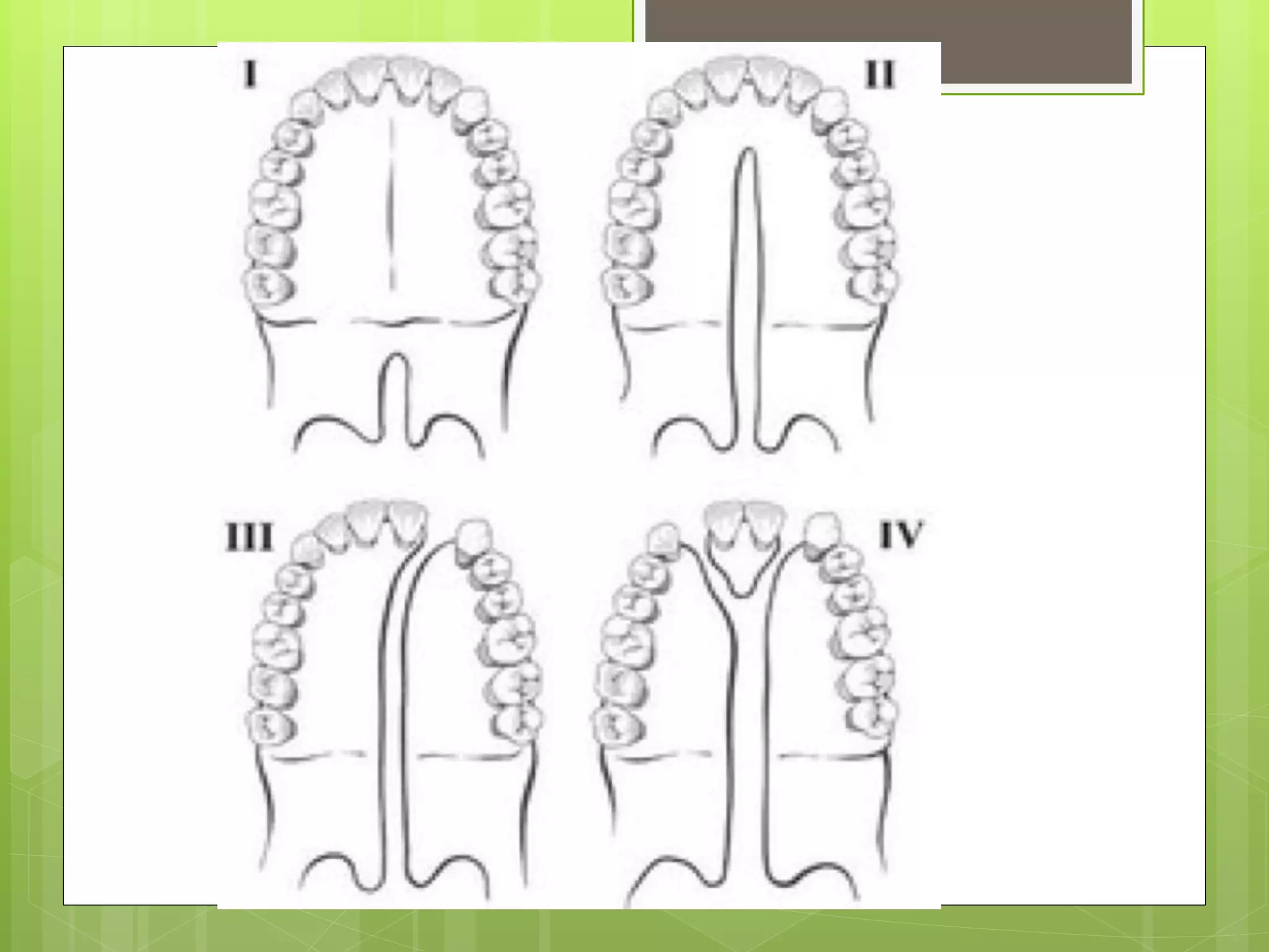 Maxillofacial congenital defect (part 1) | PPTX
