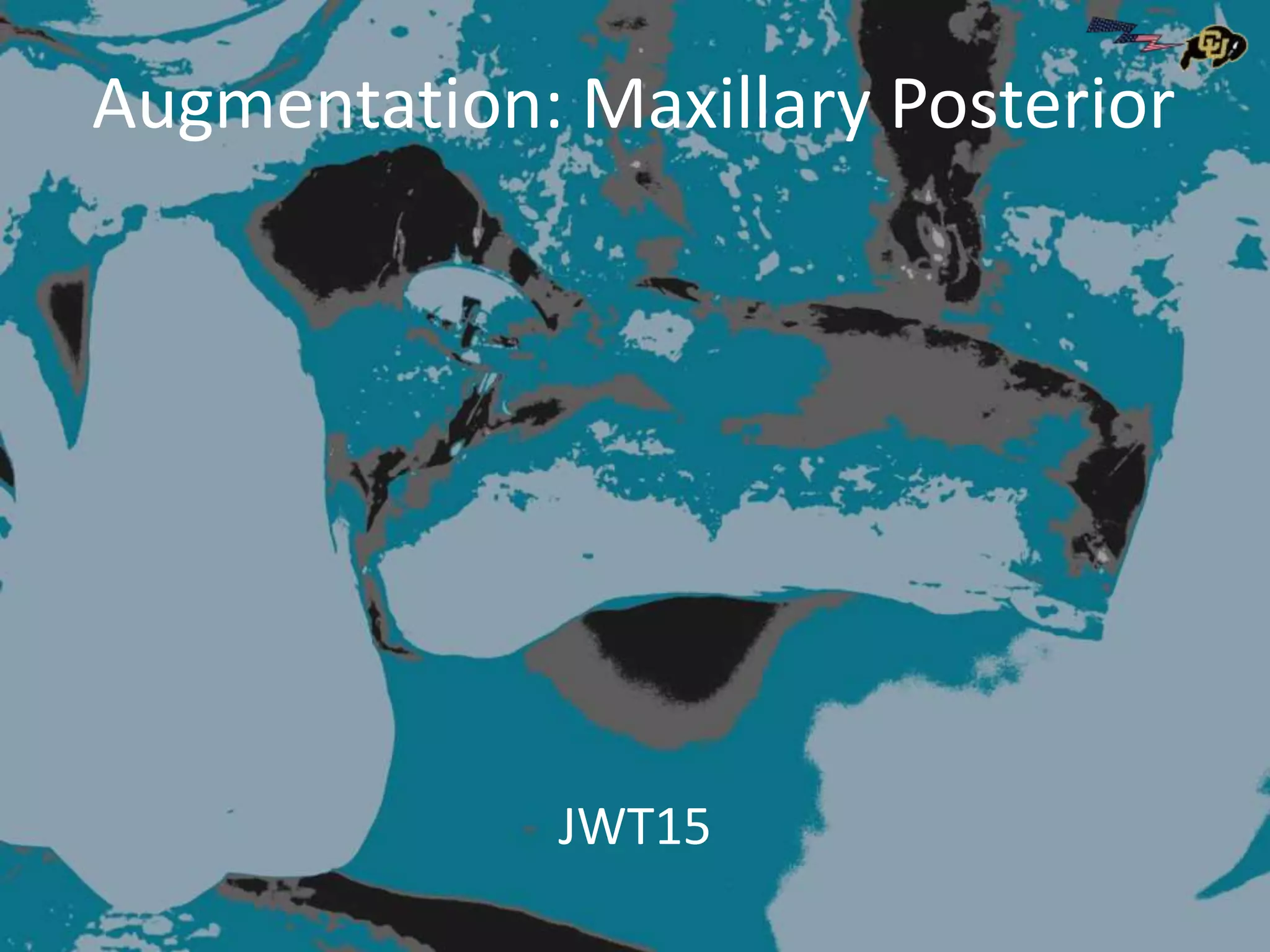 Reconstruction of the Posterior Maxilla after Peri-implantitis | PPTX