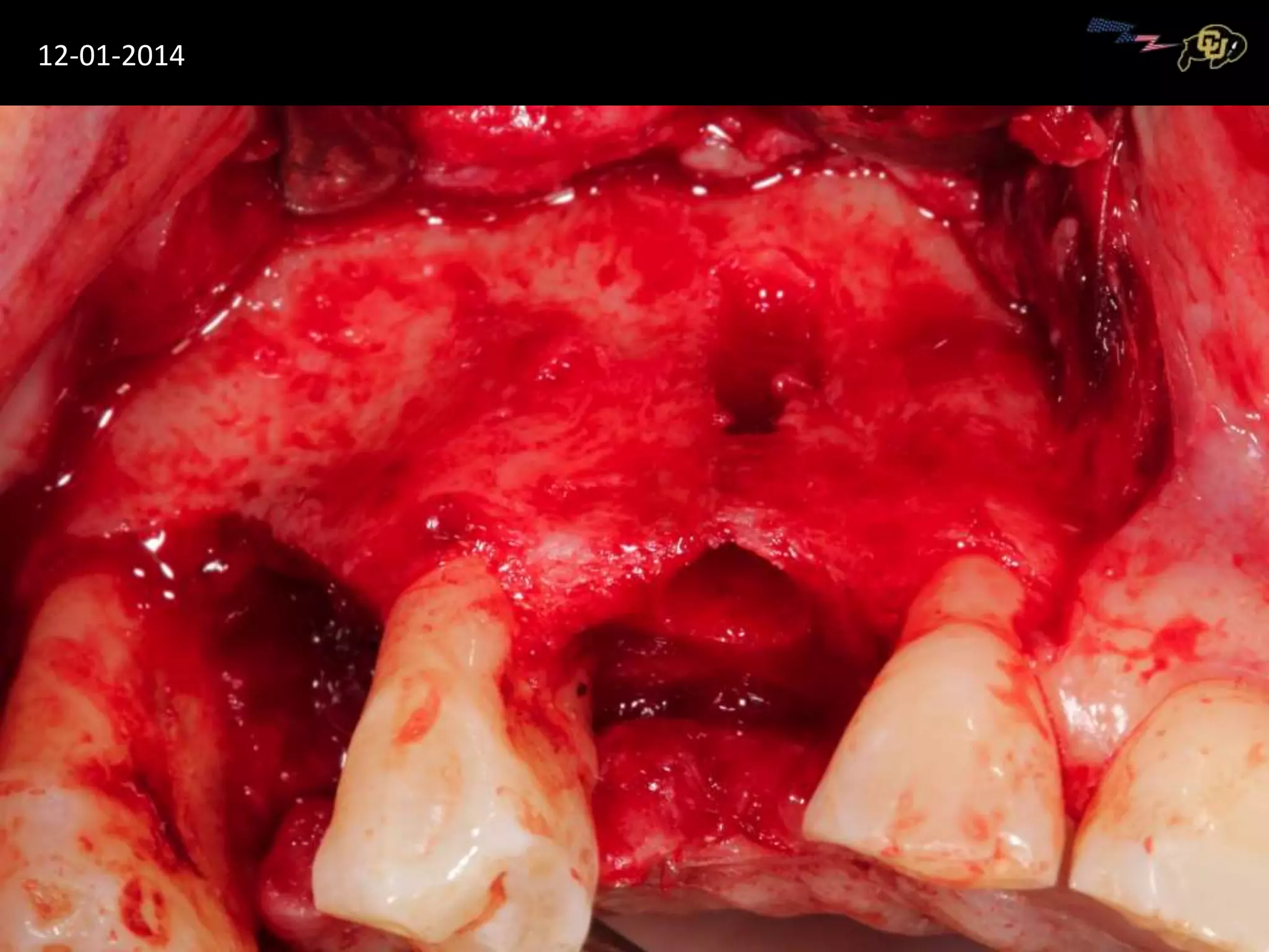 Reconstruction of the Posterior Maxilla after Peri-implantitis | PPT