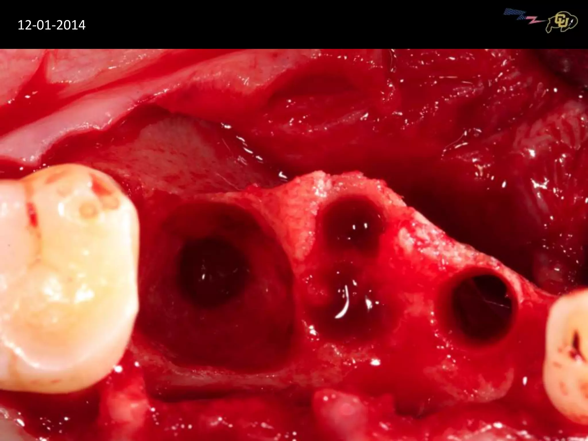 Reconstruction of the Posterior Maxilla after Peri-implantitis | PPT