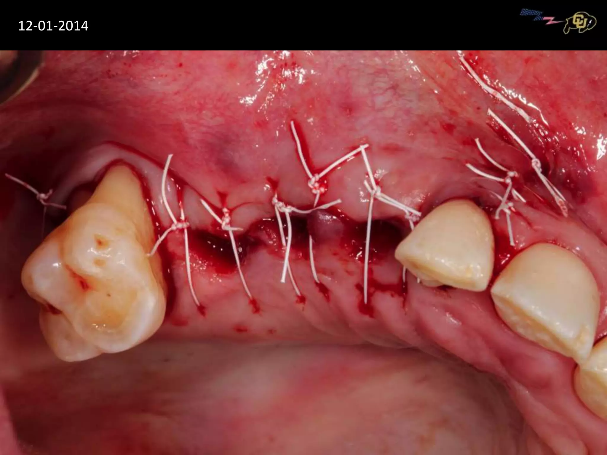 Reconstruction of the Posterior Maxilla after Peri-implantitis | PPT