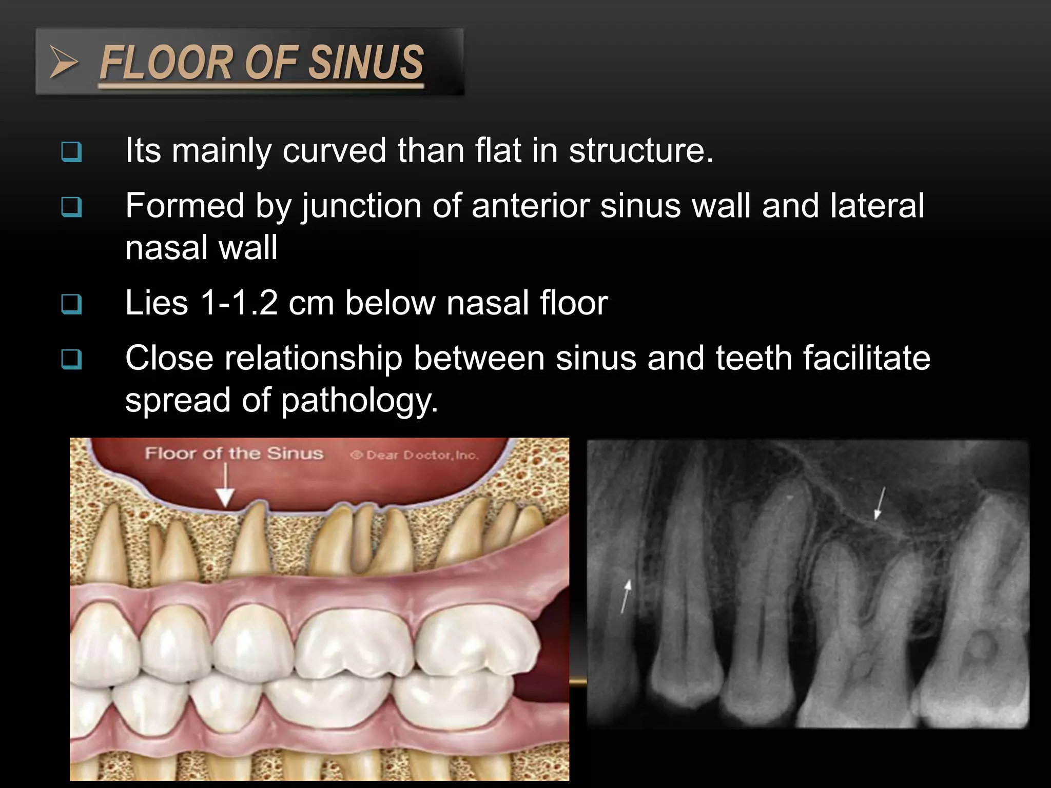 Maxillary sinus sinus | PPT