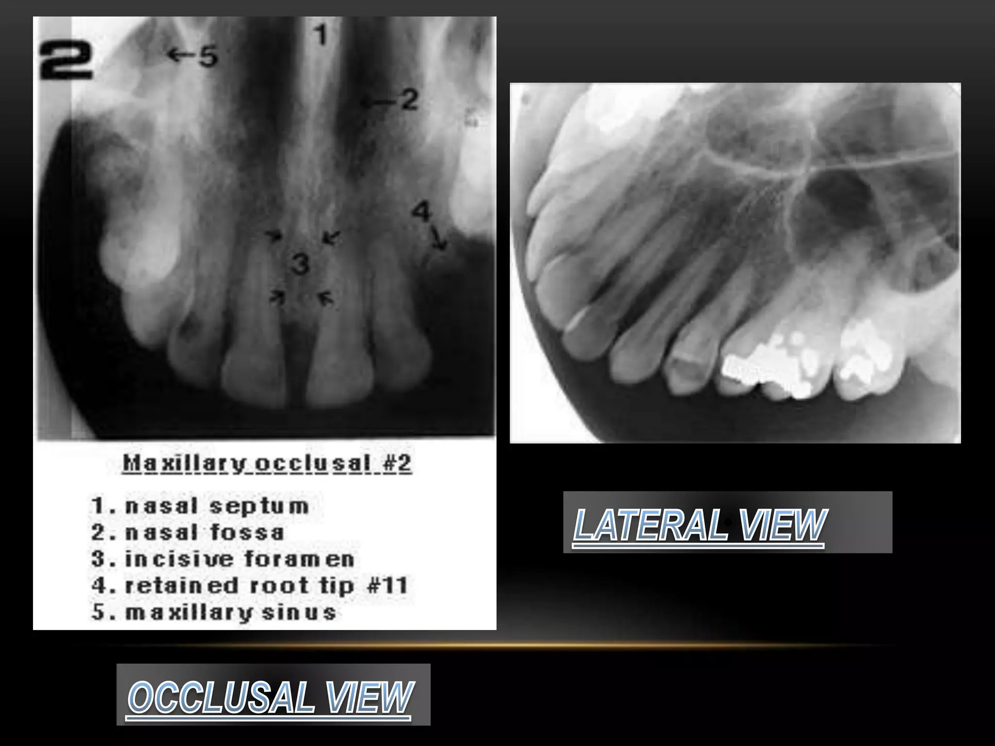 Maxillary sinus sinus | PPTX