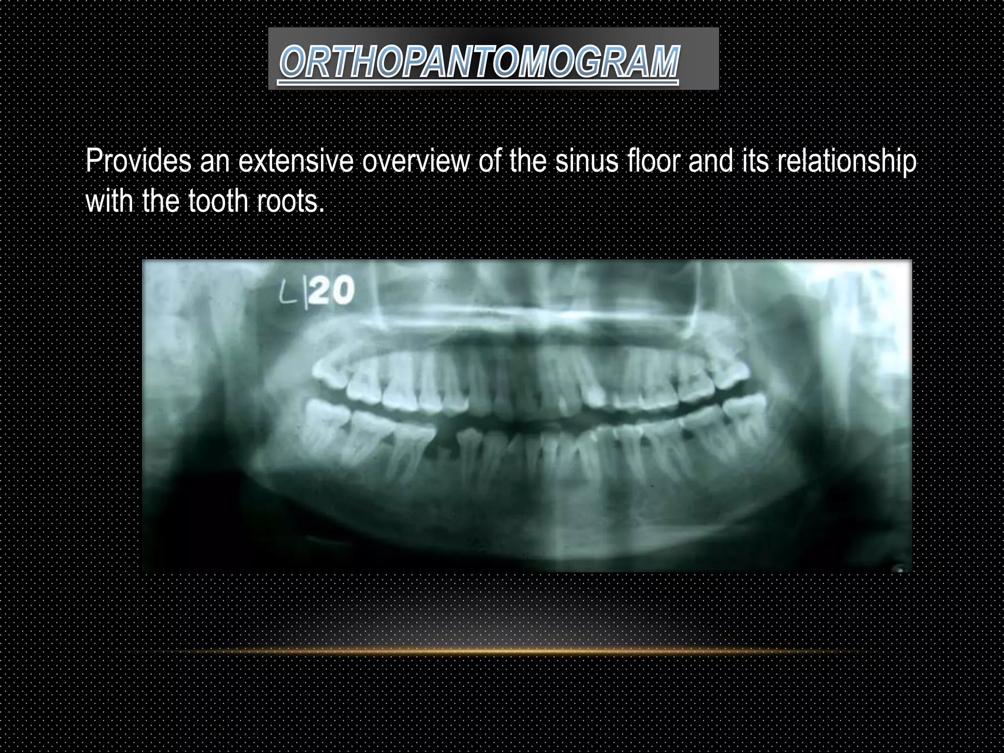 Maxillary sinus sinus | PPTX