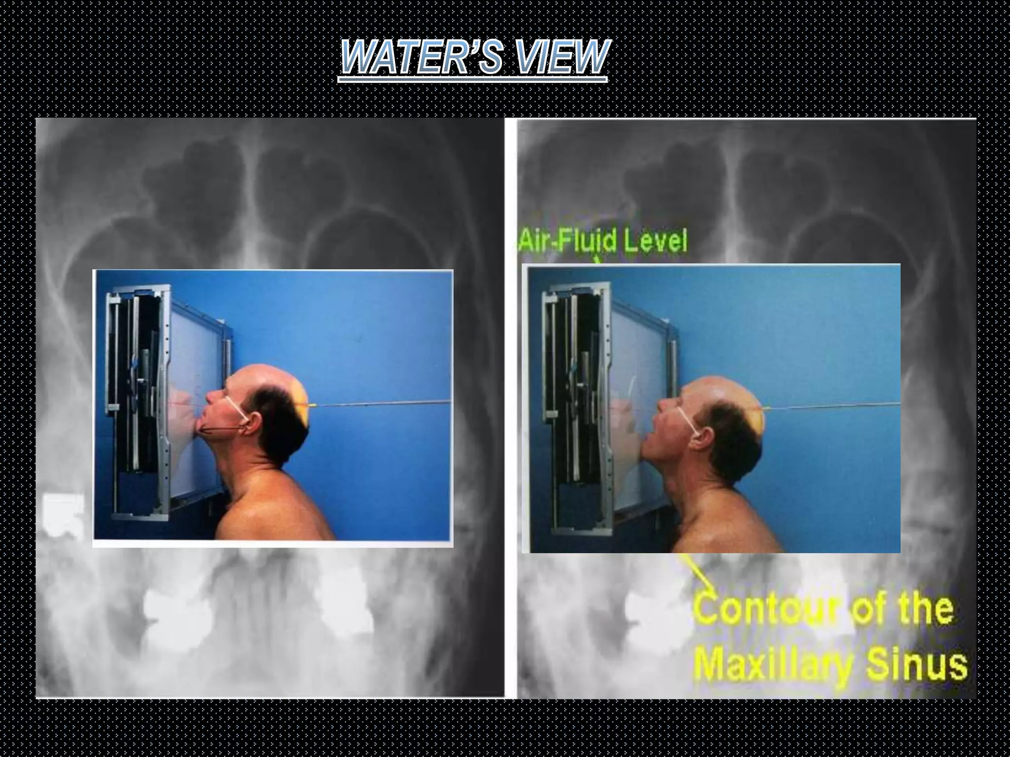 Maxillary sinus sinus | PPTX