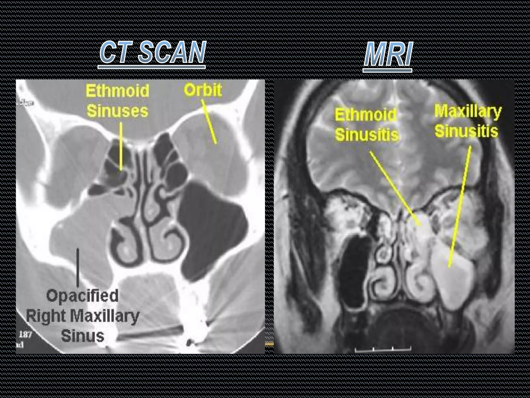 Maxillary sinus sinus | PPTX