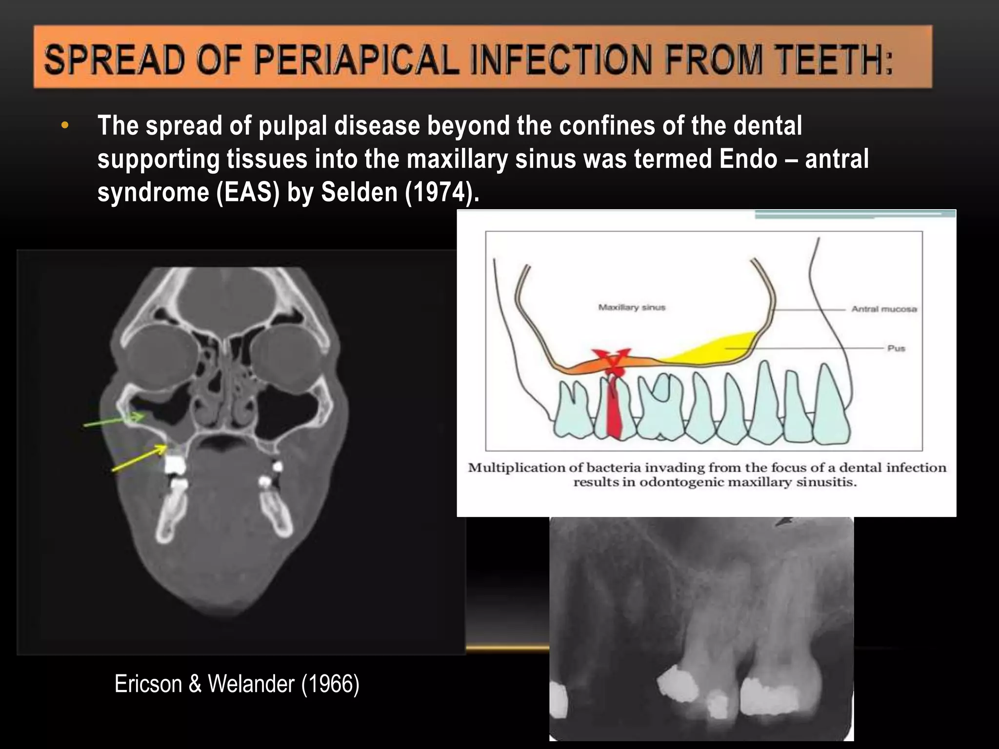 Maxillary sinus sinus | PPTX