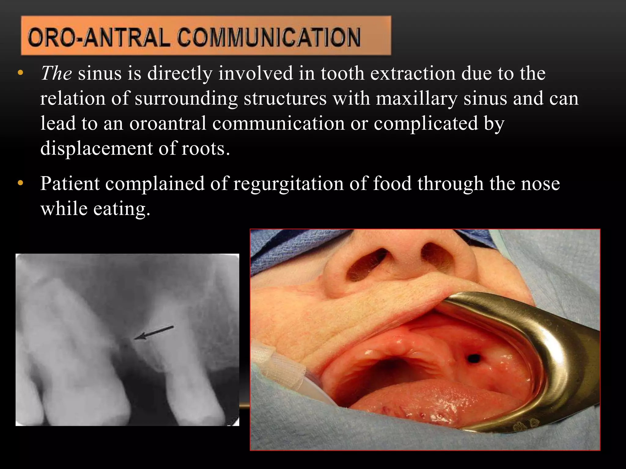 Maxillary sinus sinus | PPTX