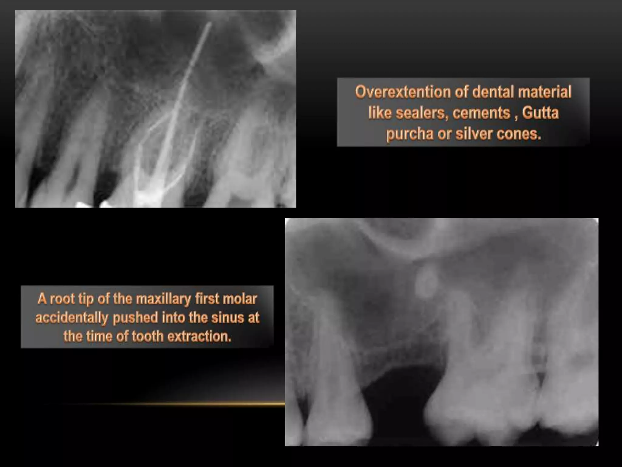 Maxillary sinus sinus | PPTX