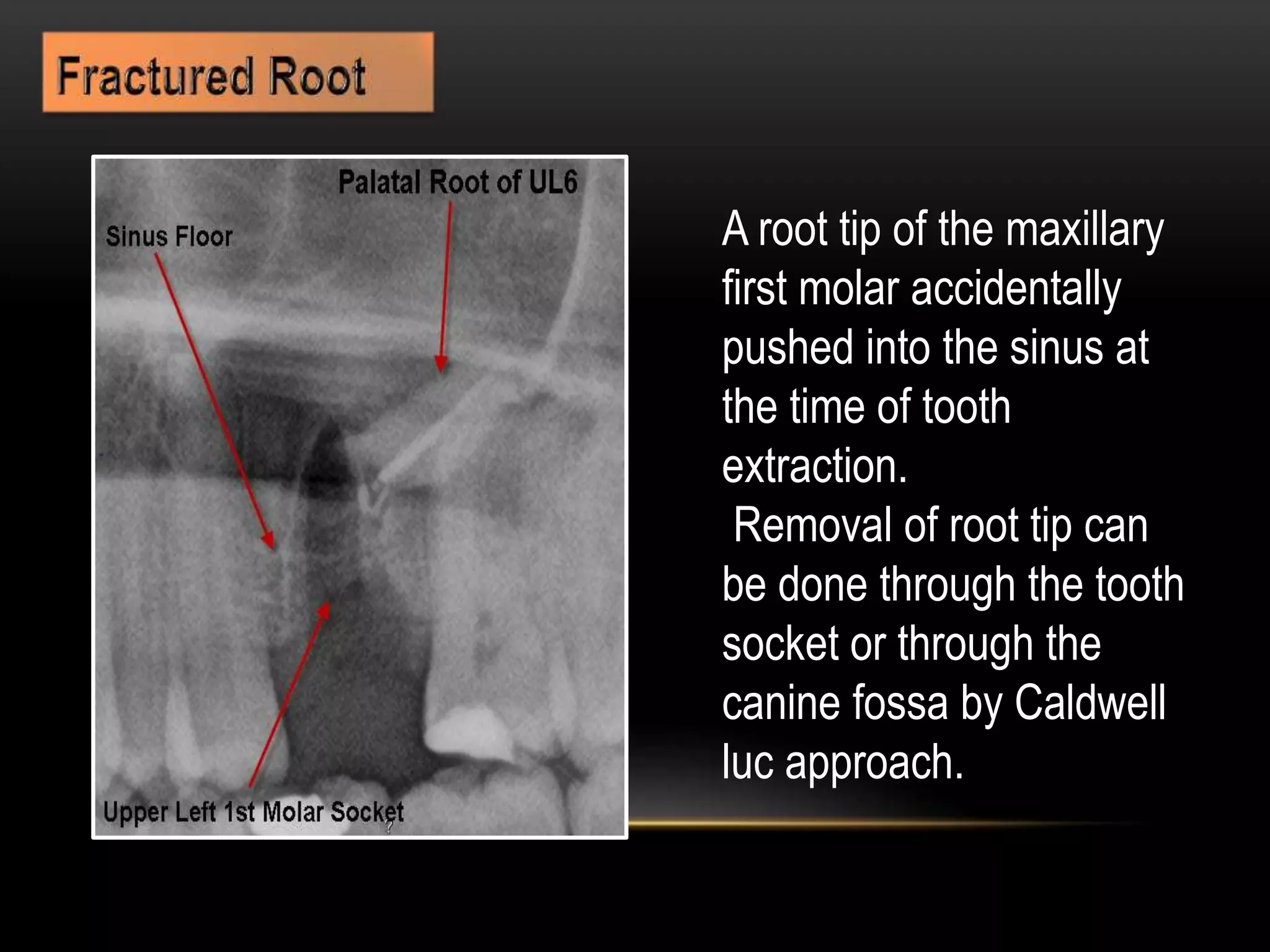 Maxillary sinus sinus | PPTX