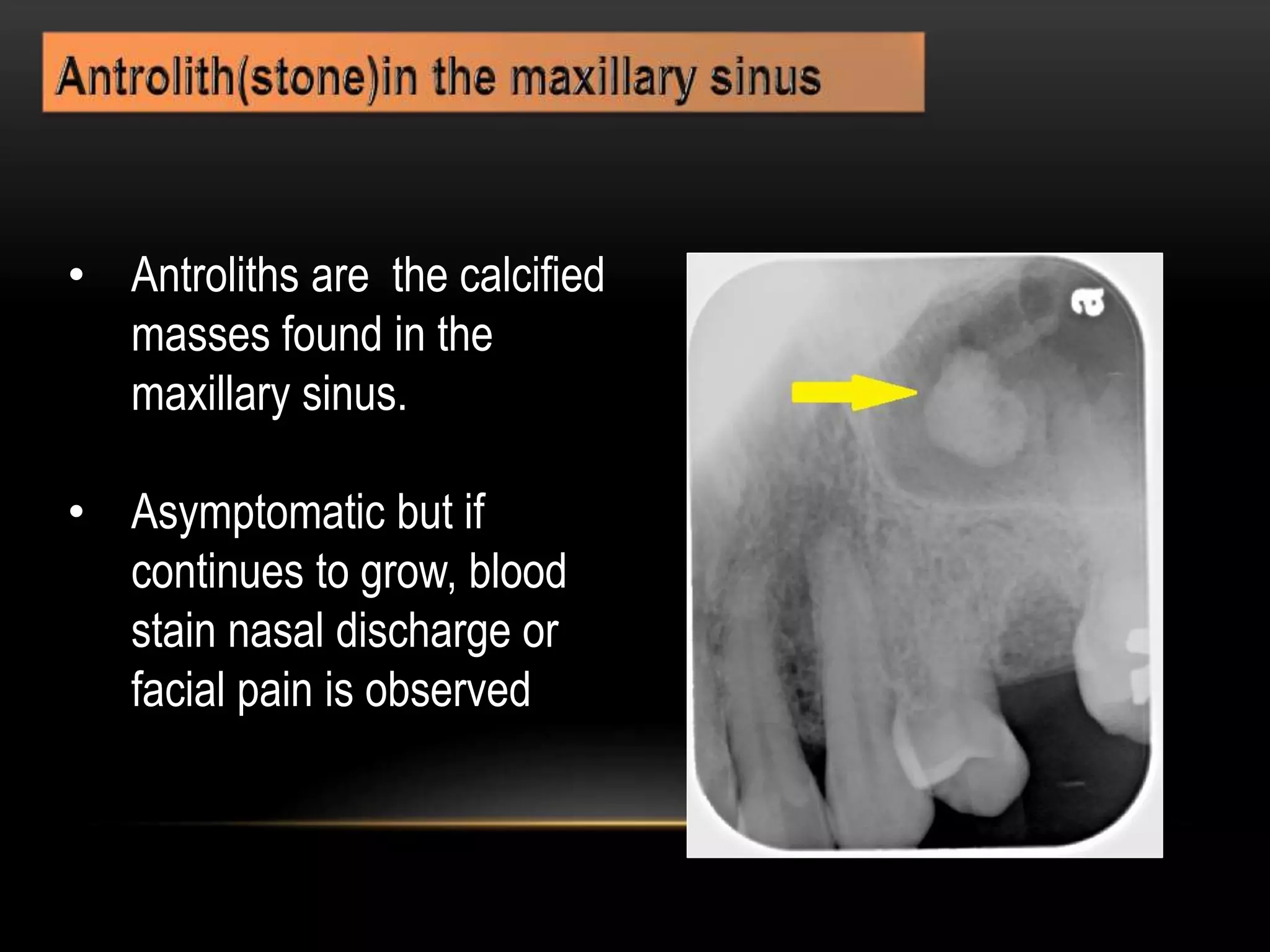 Maxillary sinus sinus | PPTX
