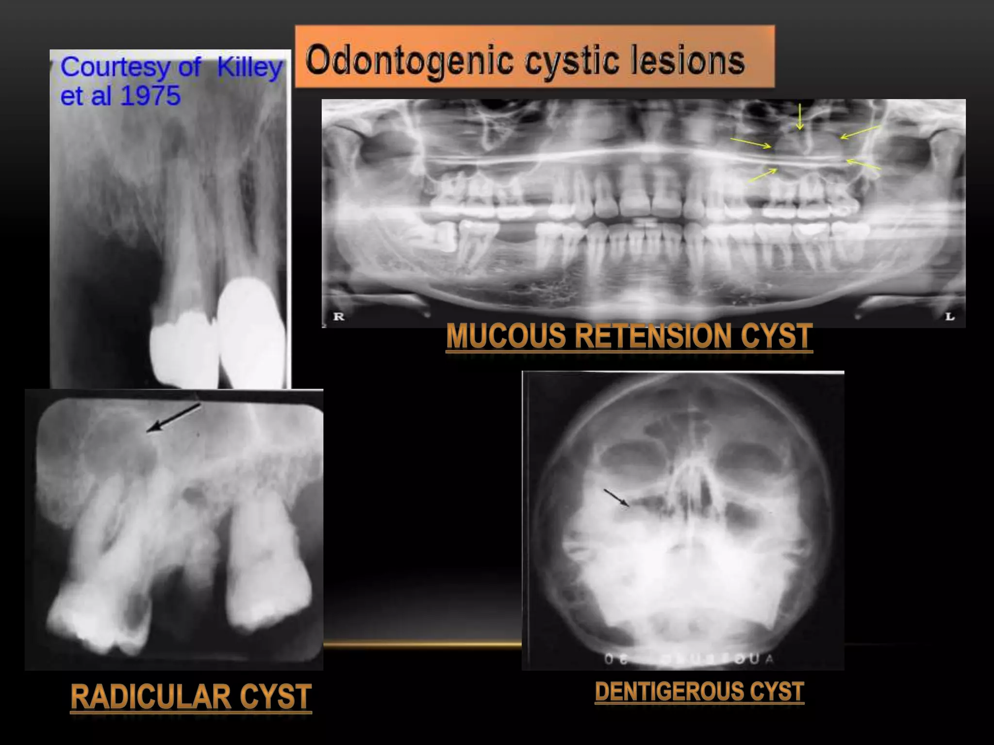 Maxillary sinus sinus | PPTX