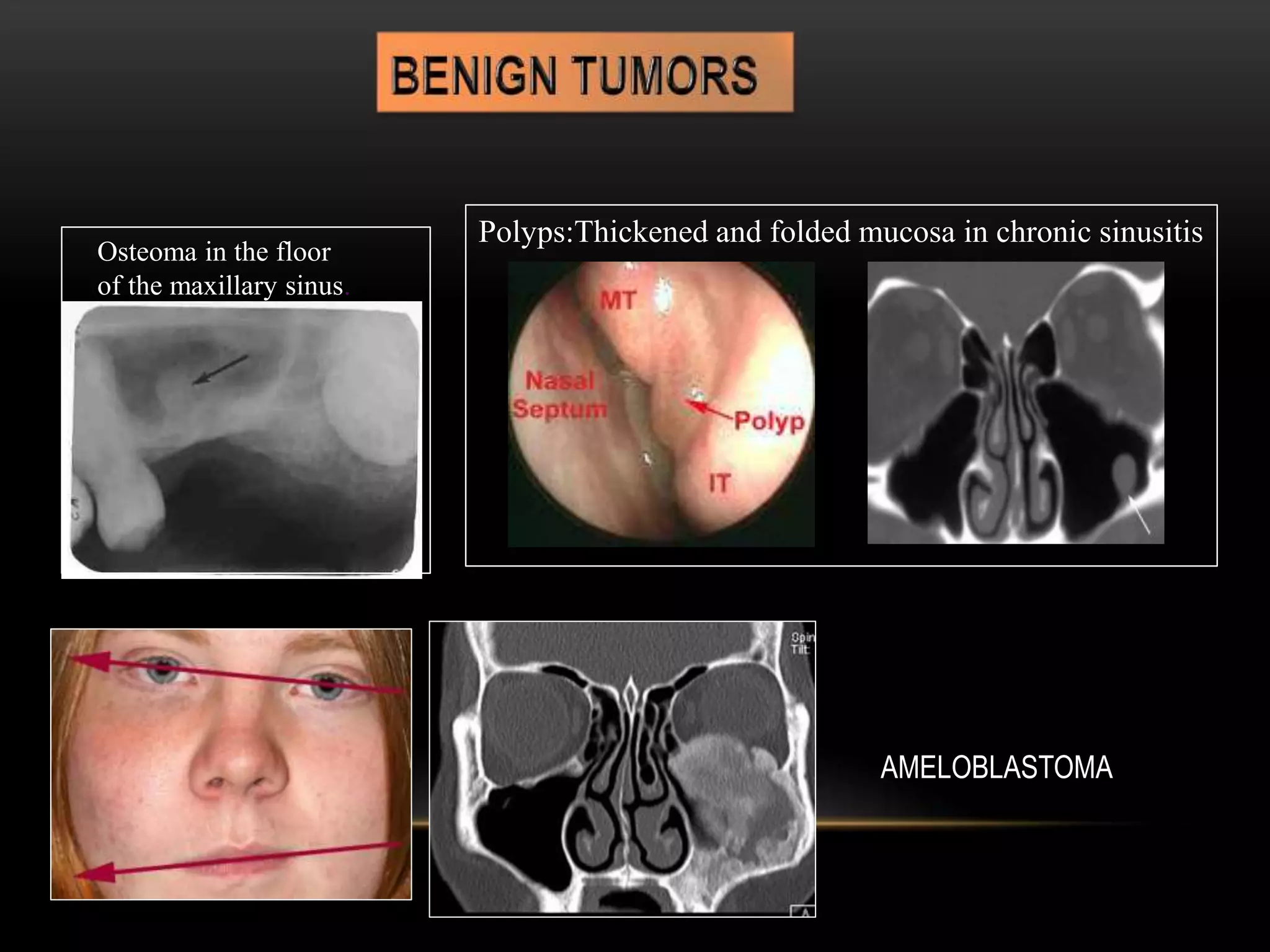 Maxillary sinus sinus | PPTX