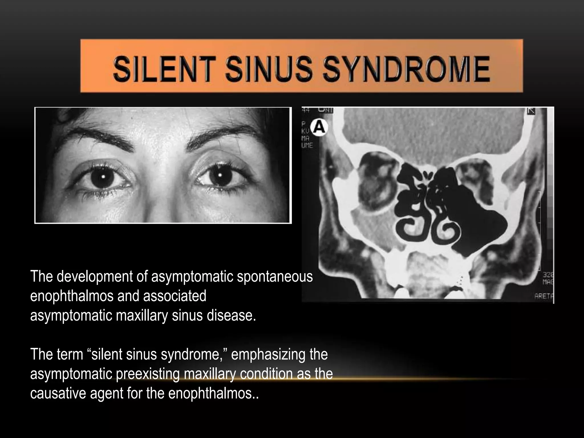 Maxillary sinus sinus | PPTX