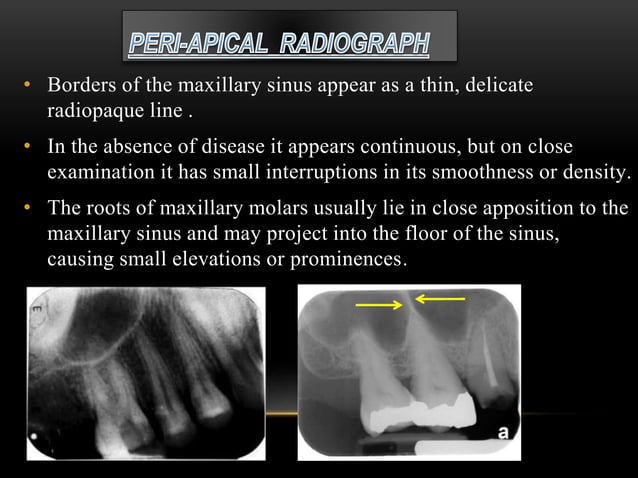 Maxillary sinus sinus | PPTX
