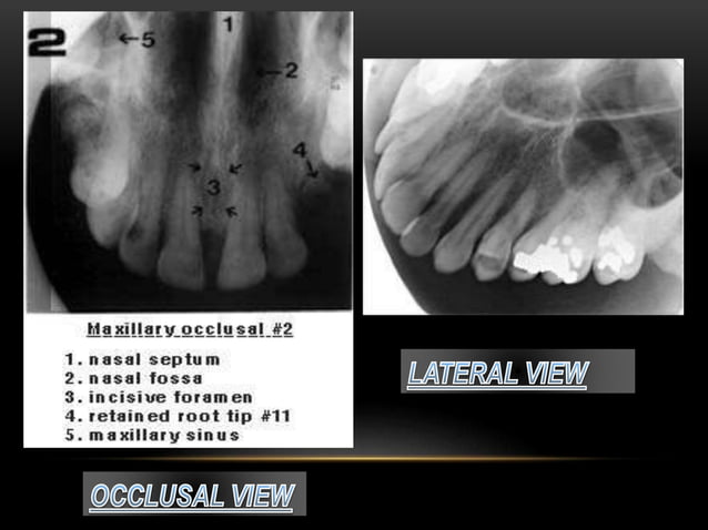 Maxillary sinus sinus | PPTX