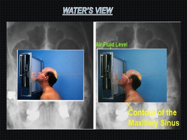 Maxillary sinus sinus | PPTX